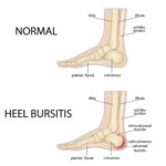 Tulang Pergelangan Kaki: Ligamen, Fungsi, Cedera, dan Perawatan ...