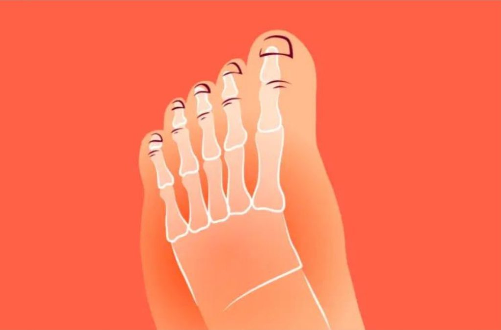 13 Obat Herbal Asam Urat yang Ampuh dan Penjelasan Lengkapnya ...