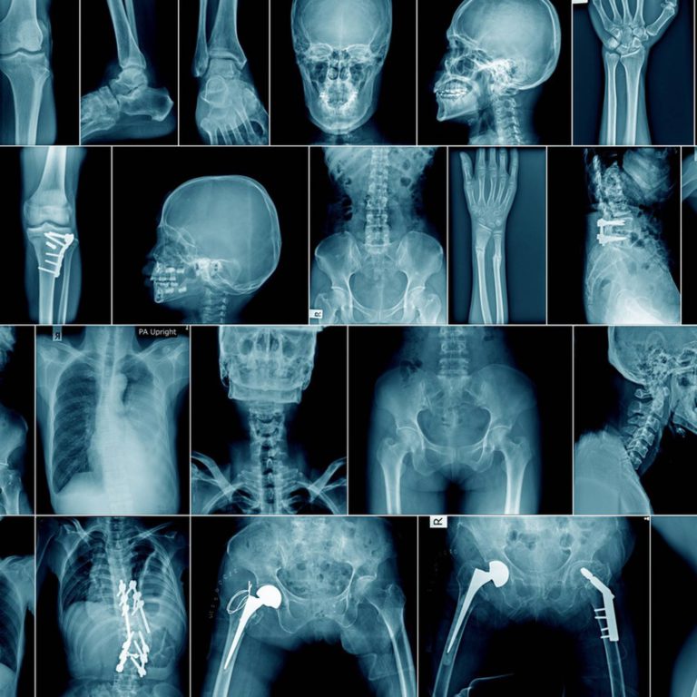 Perbedaan X Ray, Ct Scan, dan MRI Berdasarkan Fungsi dan Cara Kerja ...