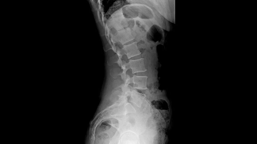 Lordosis Adalah: Pengertian, Penyebab, Serta Perbedaannya Dengan ...